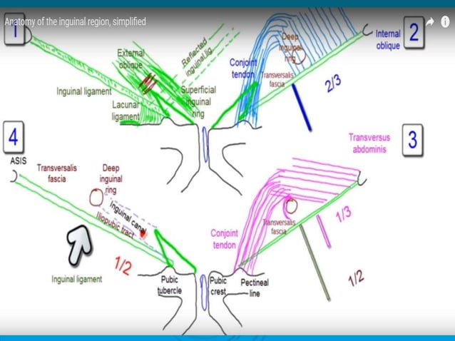 Groin anatomy inguinal hernia clinical anatomy | PPT | Death, Injury ...
