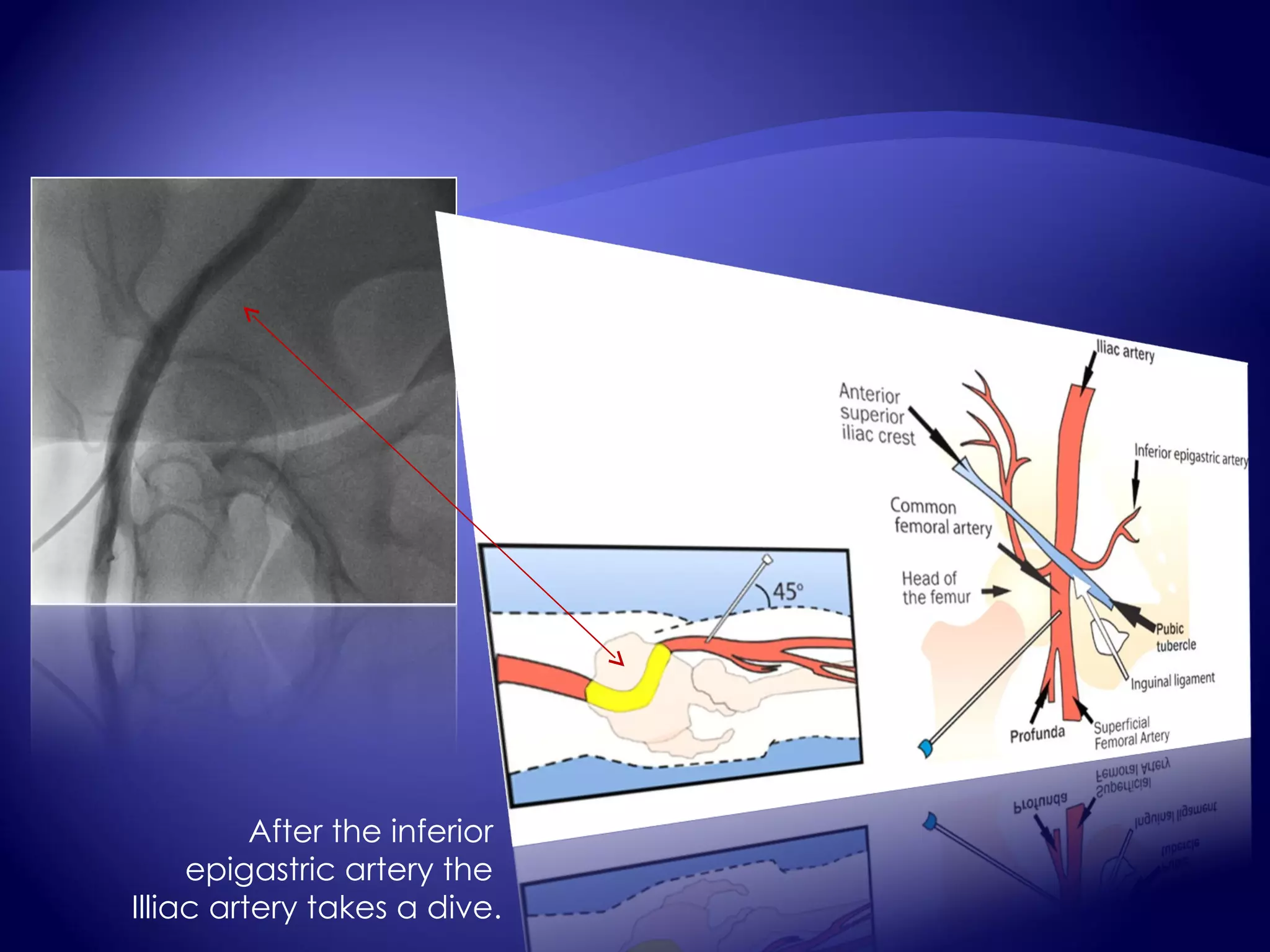 Groin complications and Management 2011 | PPT