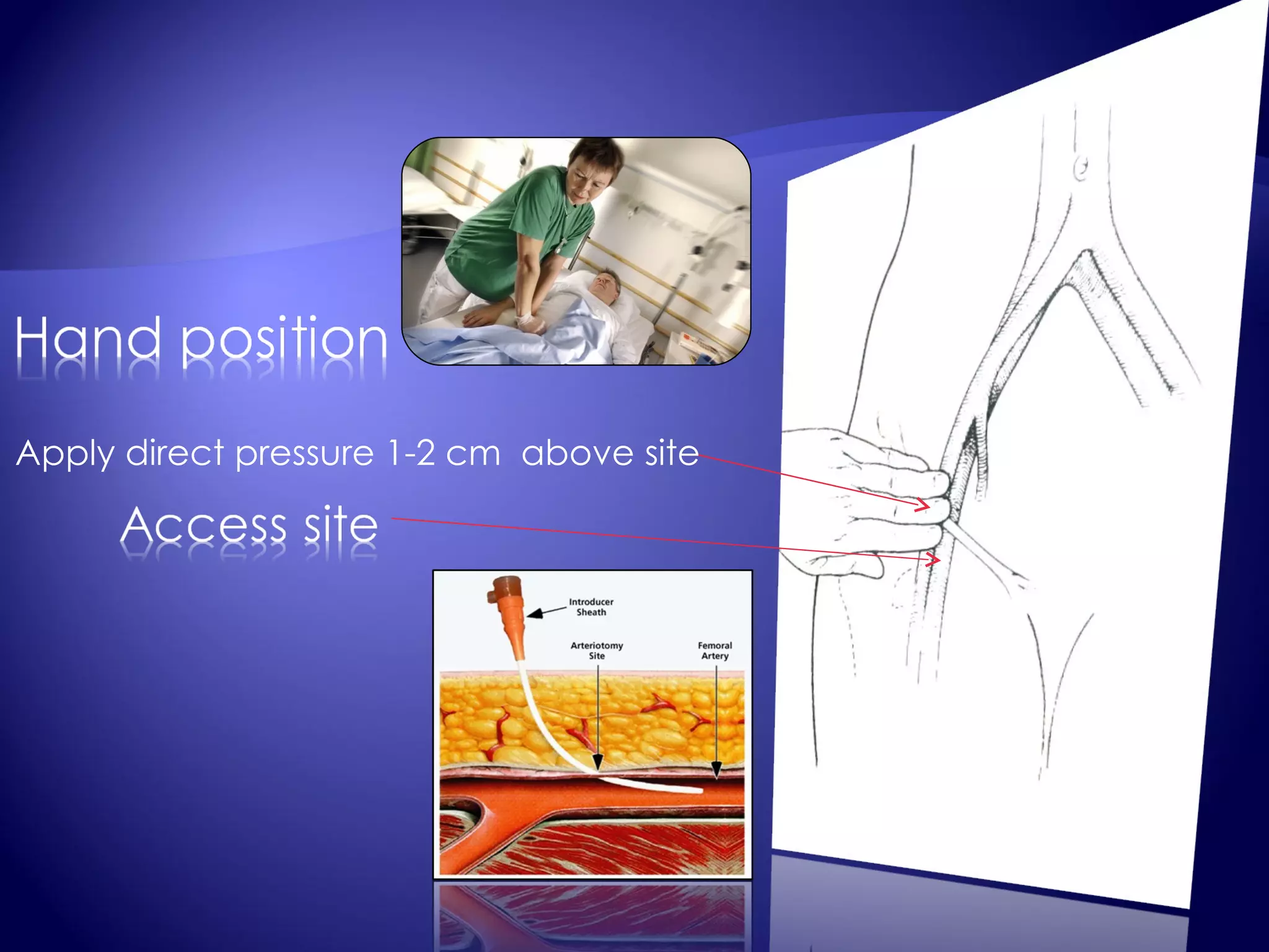 Groin complications and Management 2011 | PPT