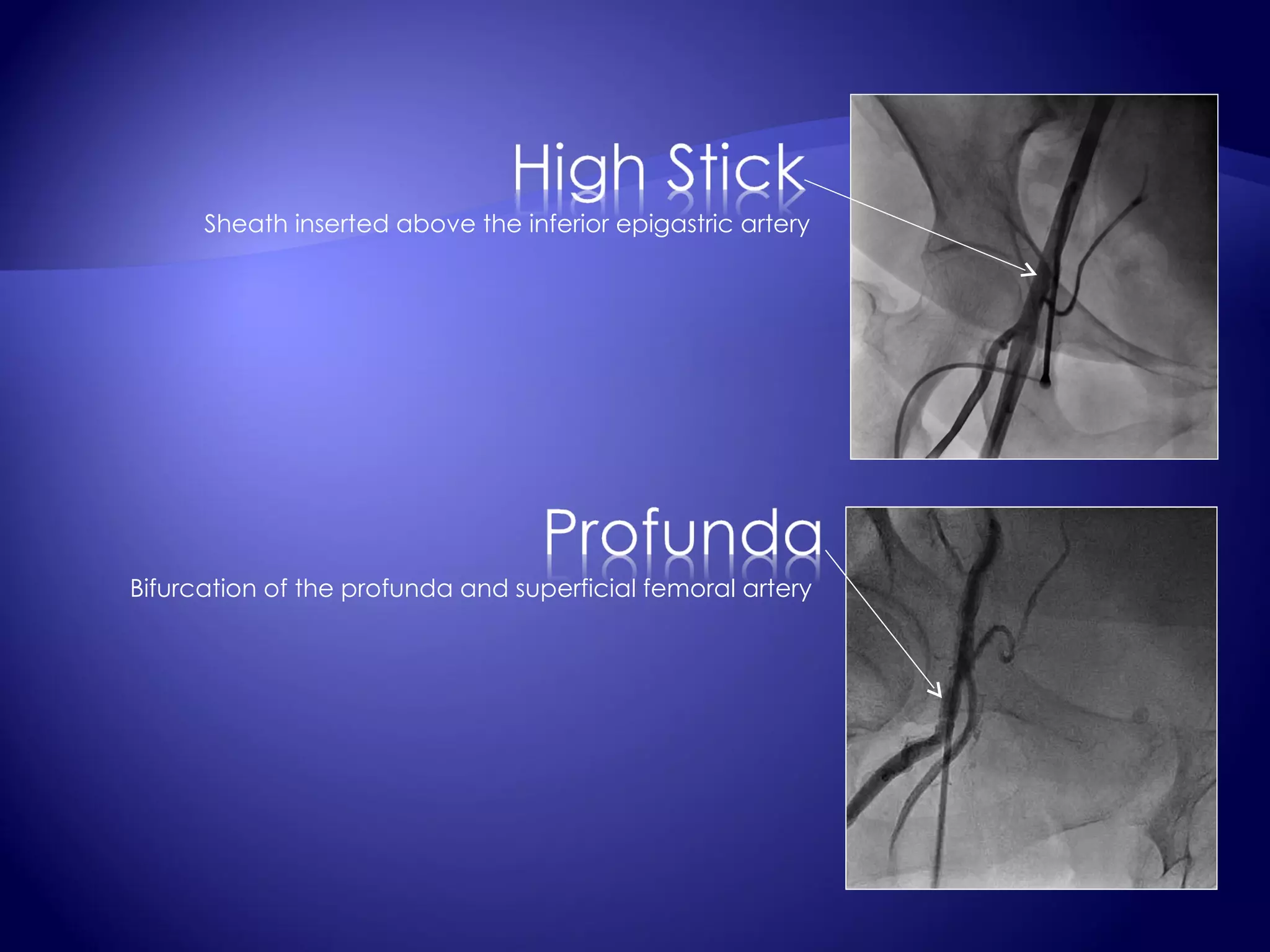 Groin complications and Management 2011 | PPT