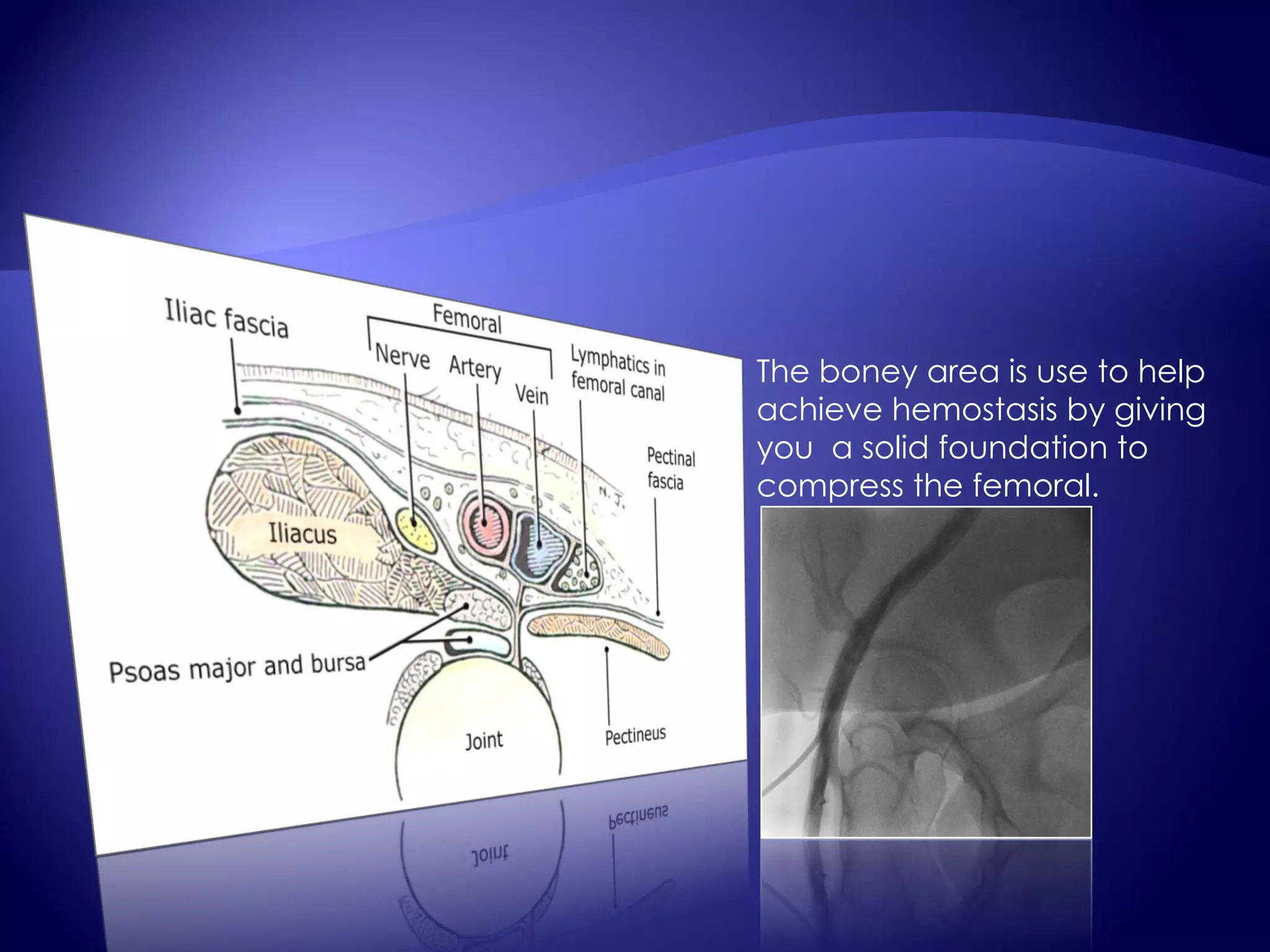 Groin complications and Management 2011 | PPT
