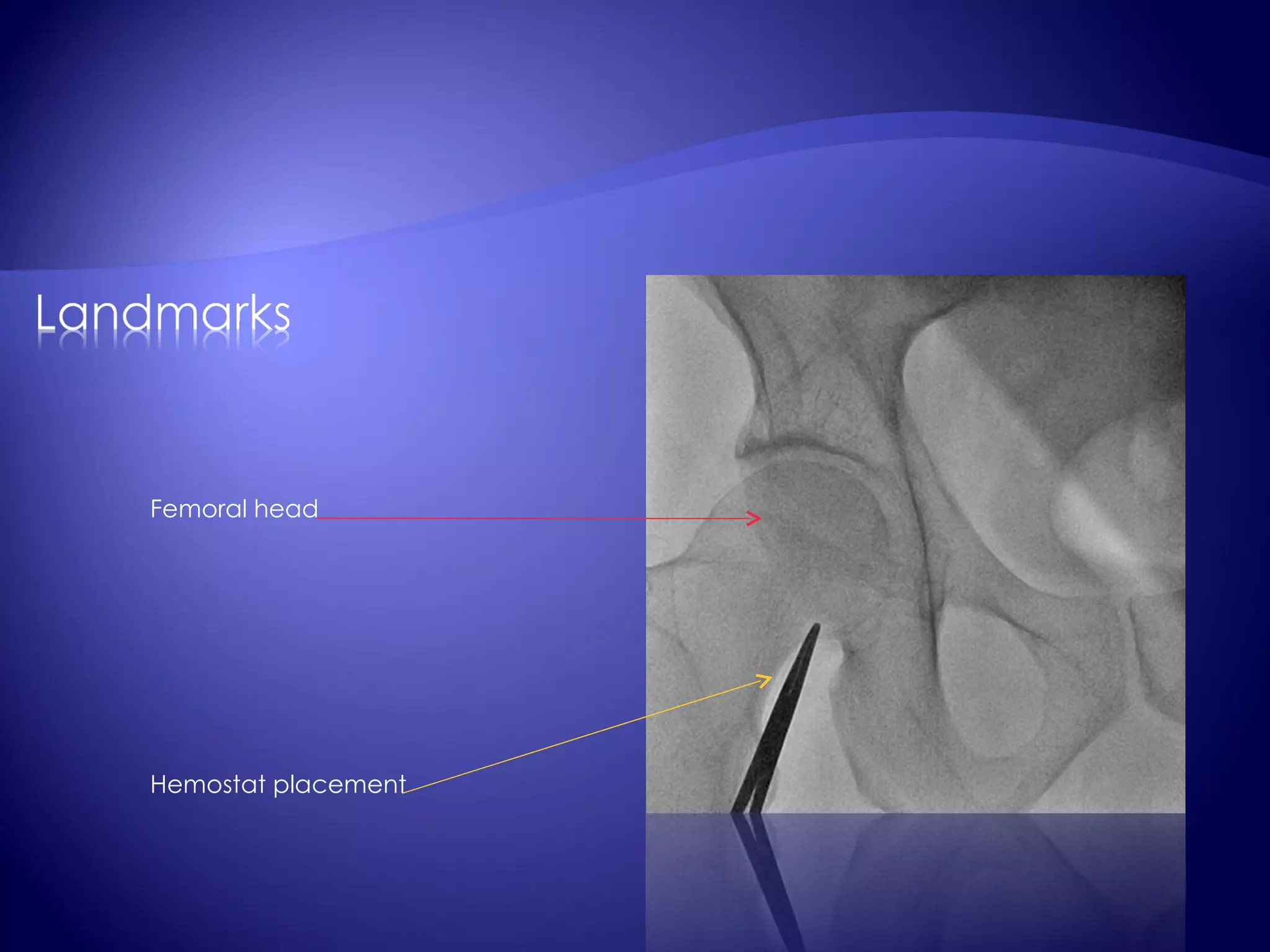 Groin complications and Management 2011 | PPT