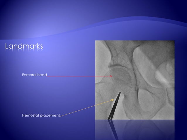 Groin complications and Management 2011 | PPT