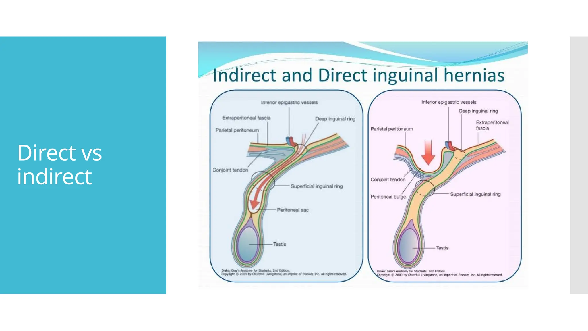 Groin Hernias types history and operations | PPT