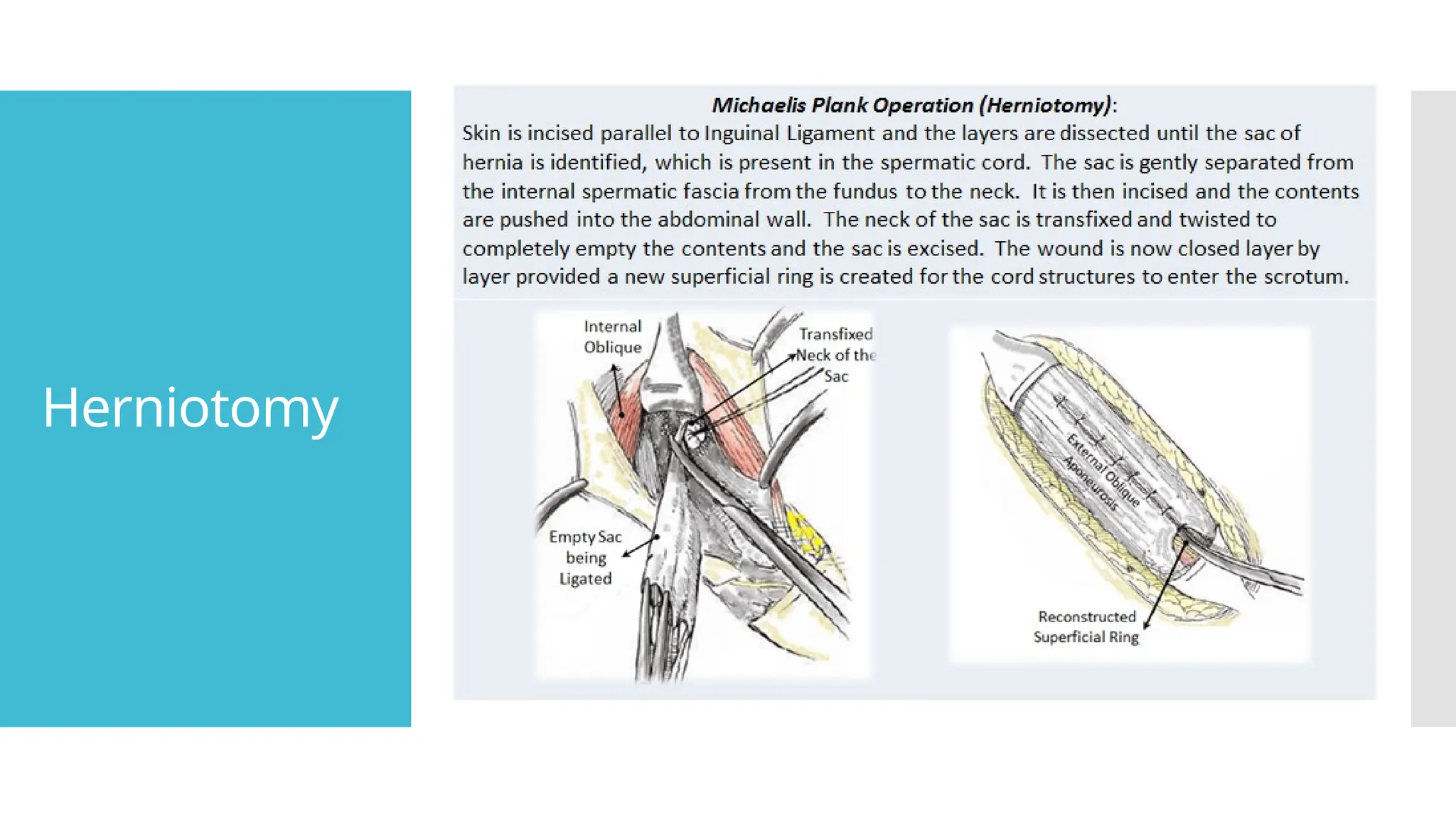 Groin Hernias types history and operations | PPT