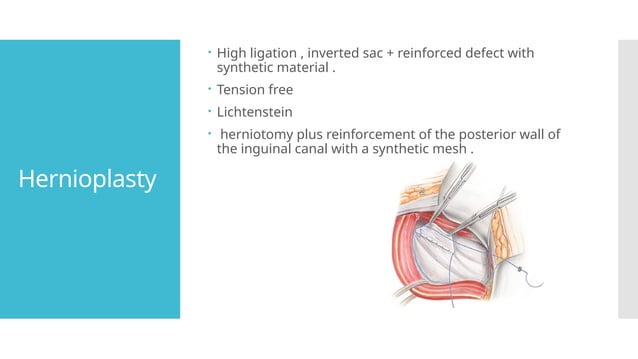 Groin Hernias types history and operations | PPT