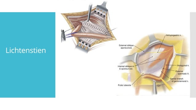 Groin Hernias types history and operations | PPT
