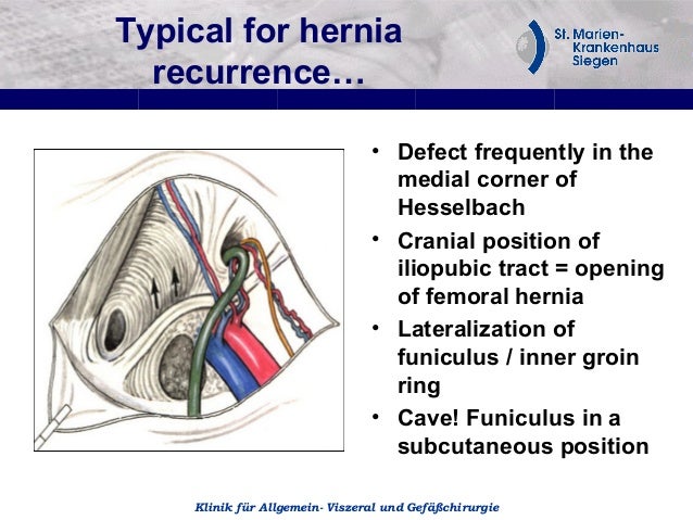 Approach To Groin Hernias. _ Open femoral hernia repair: one skin ...