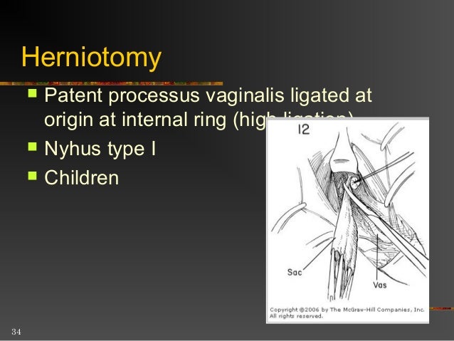 Uhd 4k Realtime Unedited Pediatric Inguinal Herniotomy