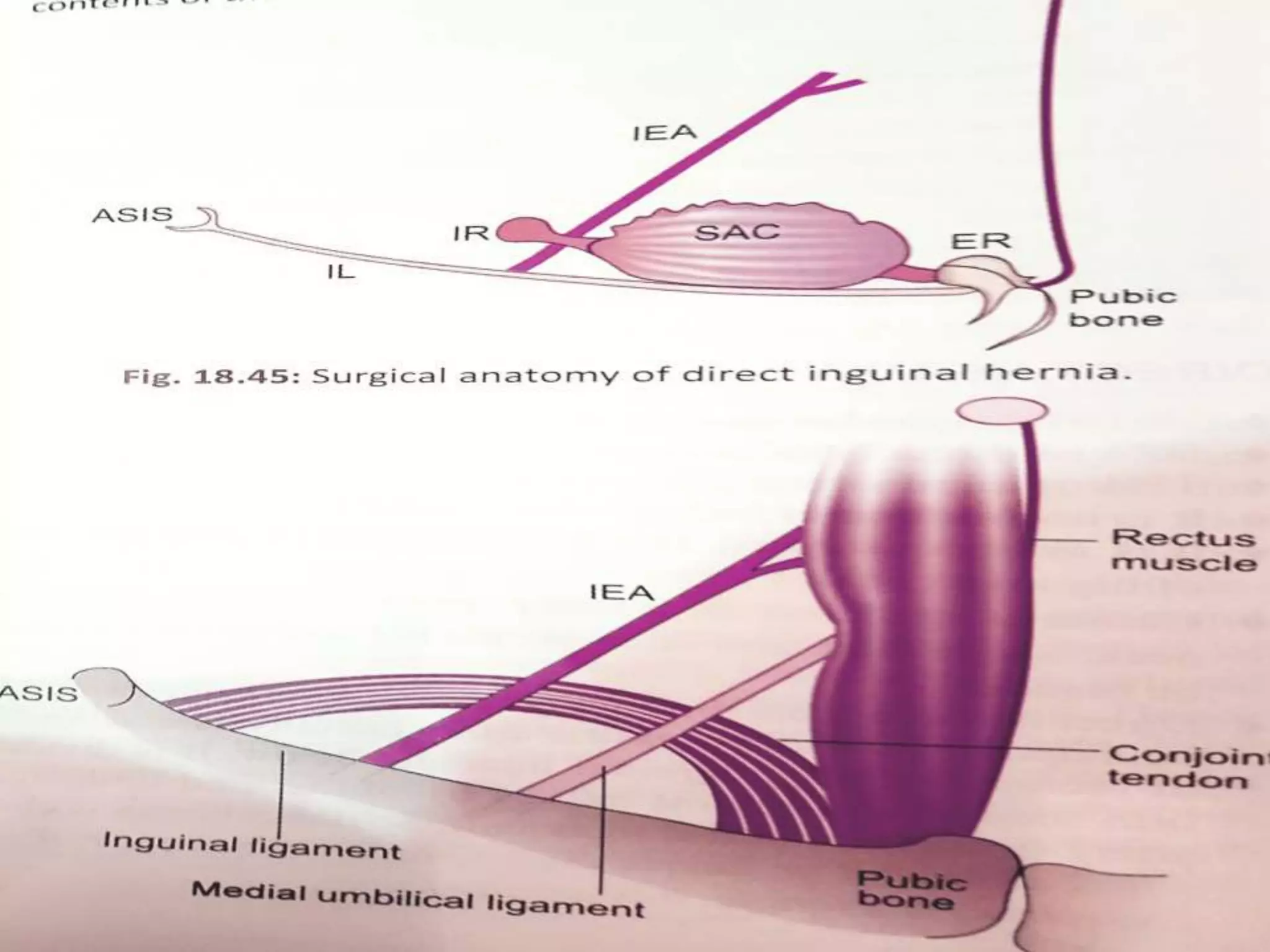 Groin hernias | PPTX