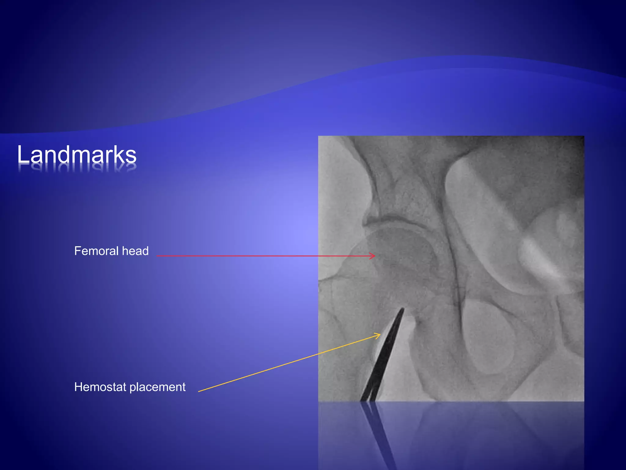 Groin management 2013 | PPTX