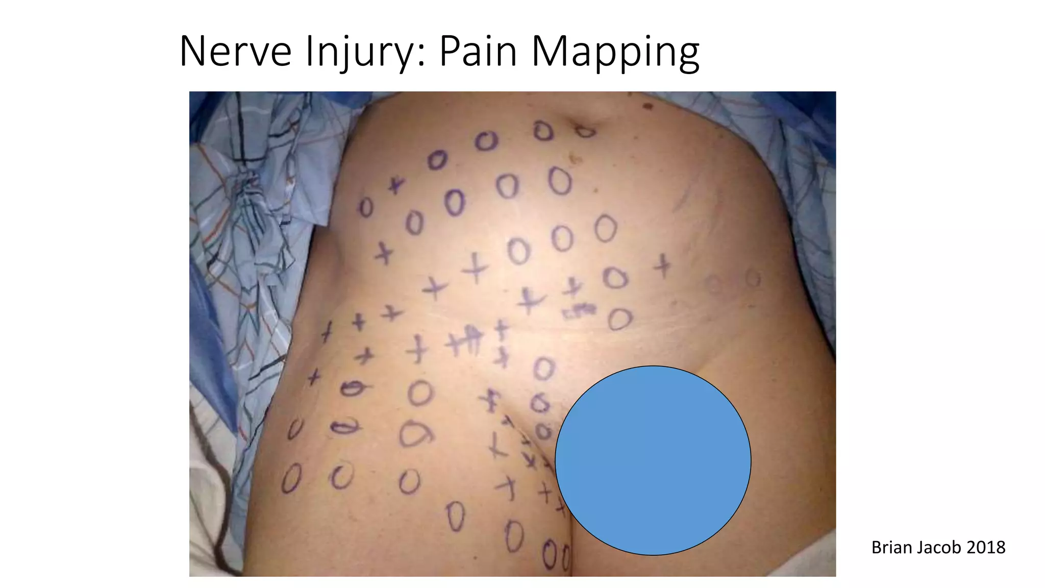 Groin pain and hernia exam final by dr. brian jacob | PPT