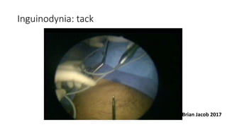Groin pain and hernia exam final by dr. brian jacob | PPTX