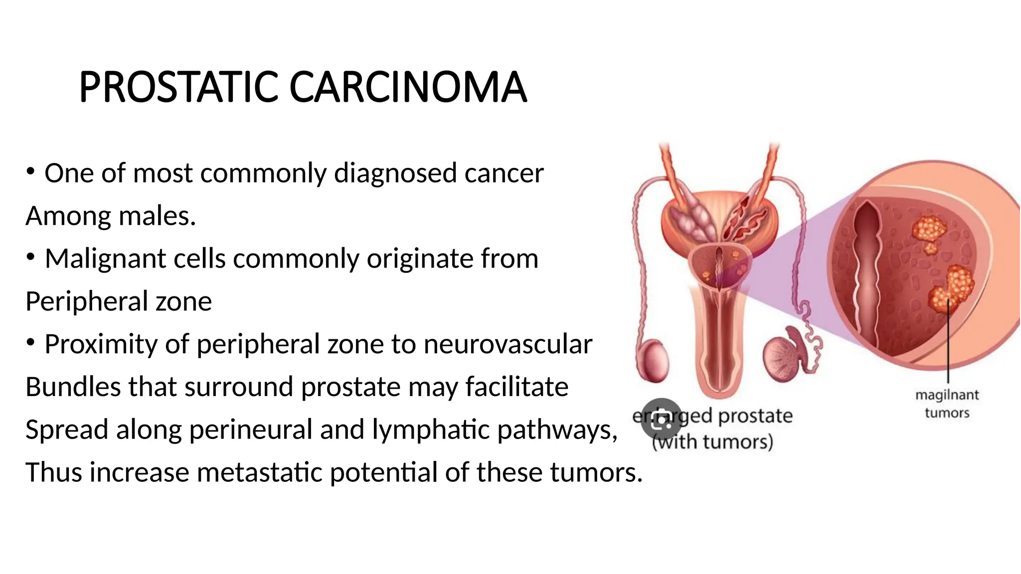 GROSS ANATOMY OF PROSTATE GLAND WITH CLINICALS (1).pptx