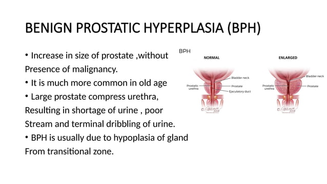 GROSS ANATOMY OF PROSTATE GLAND WITH CLINICALS (1).pptx