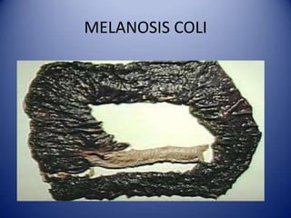 GrosS LARGE BOWEL DR N P TIWARI | PPT