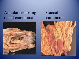 GrosS LARGE BOWEL DR N P TIWARI | PPT