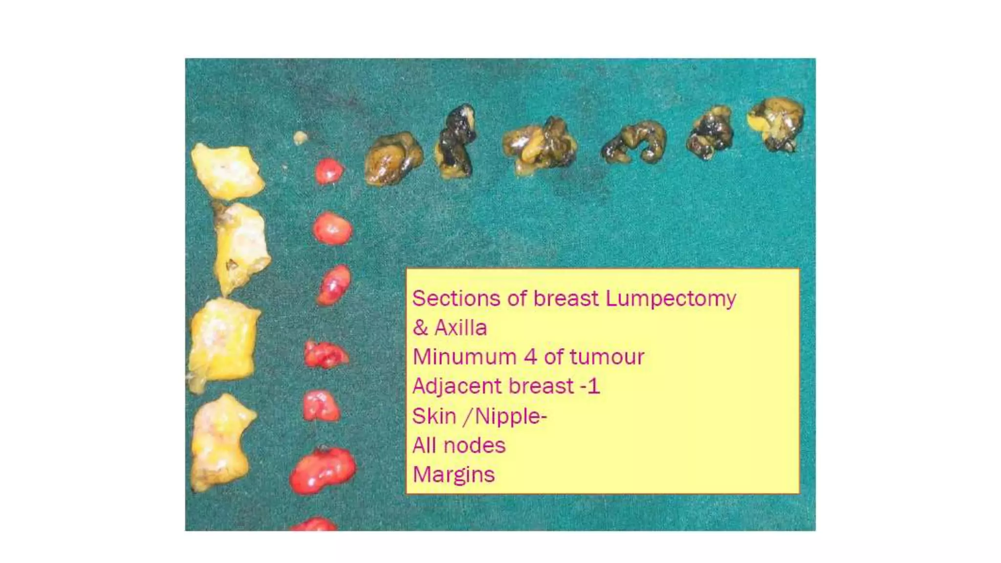 GROSSING OF BREAST.pptx
