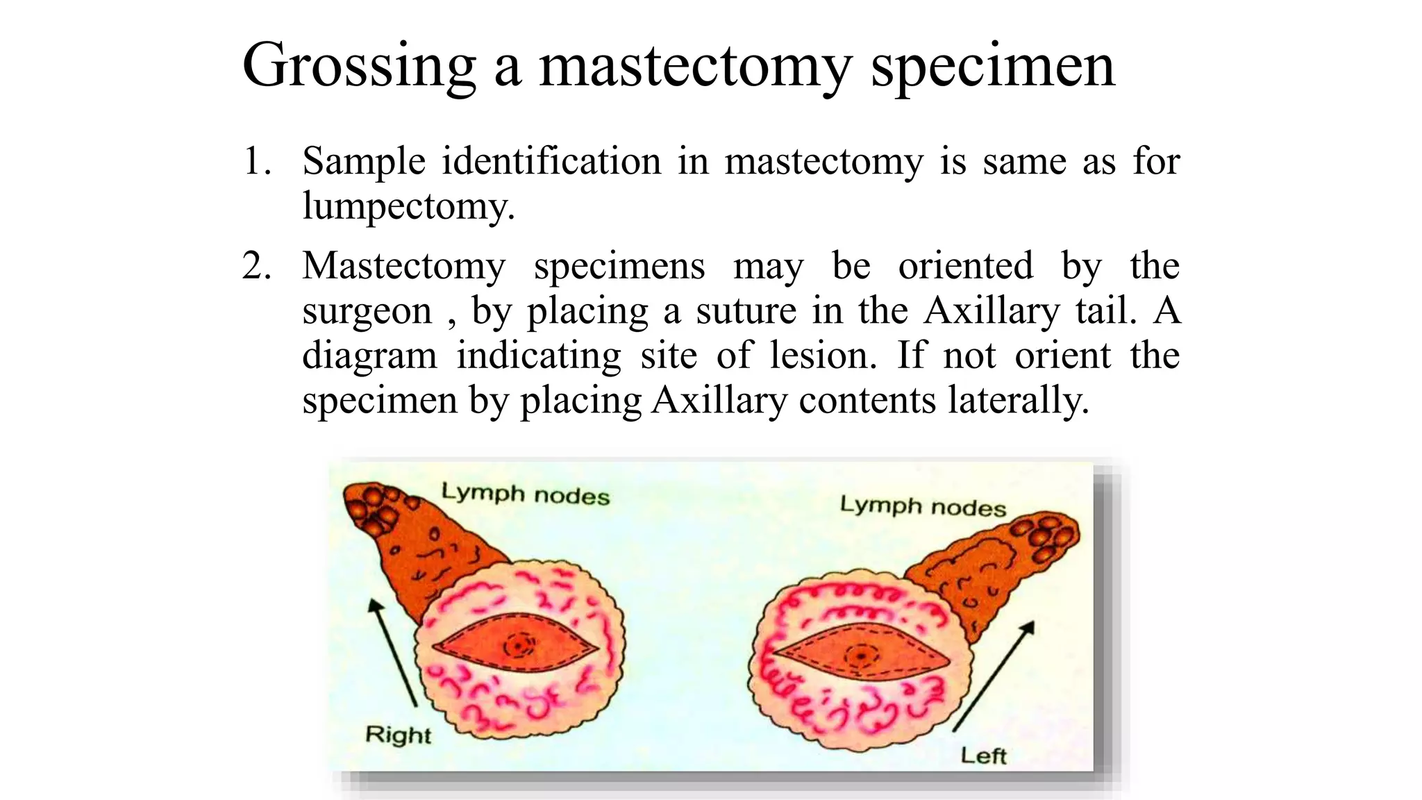 GROSSING OF BREAST.pptx