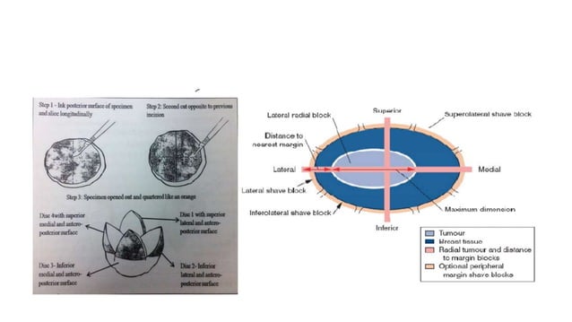 GROSSING OF BREAST.pptx