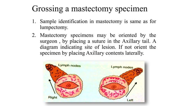 GROSSING OF BREAST.pptx