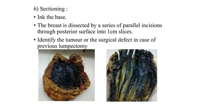 GROSSING OF BREAST.pptx