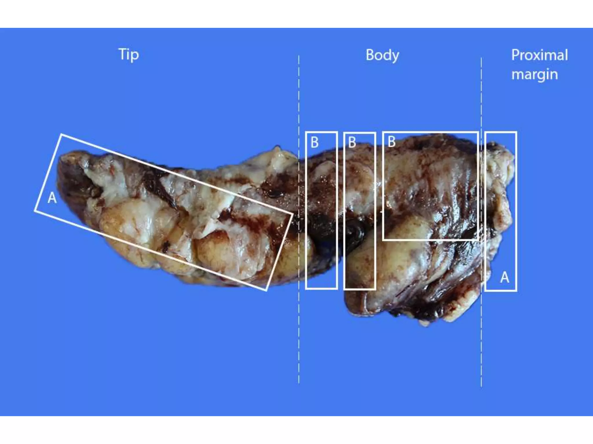 Grossing of Gastrointestinal specimens | PPTX