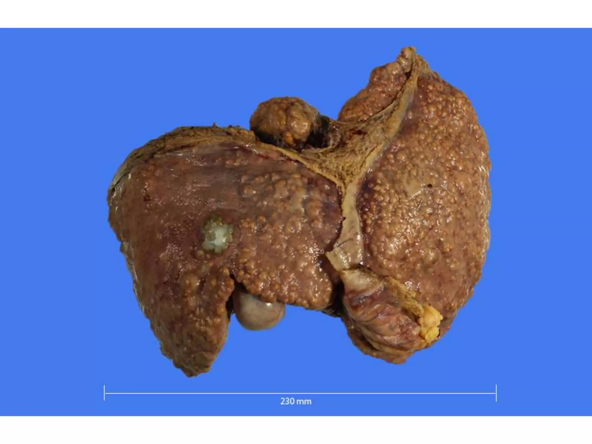 Grossing of Gastrointestinal specimens | PPTX