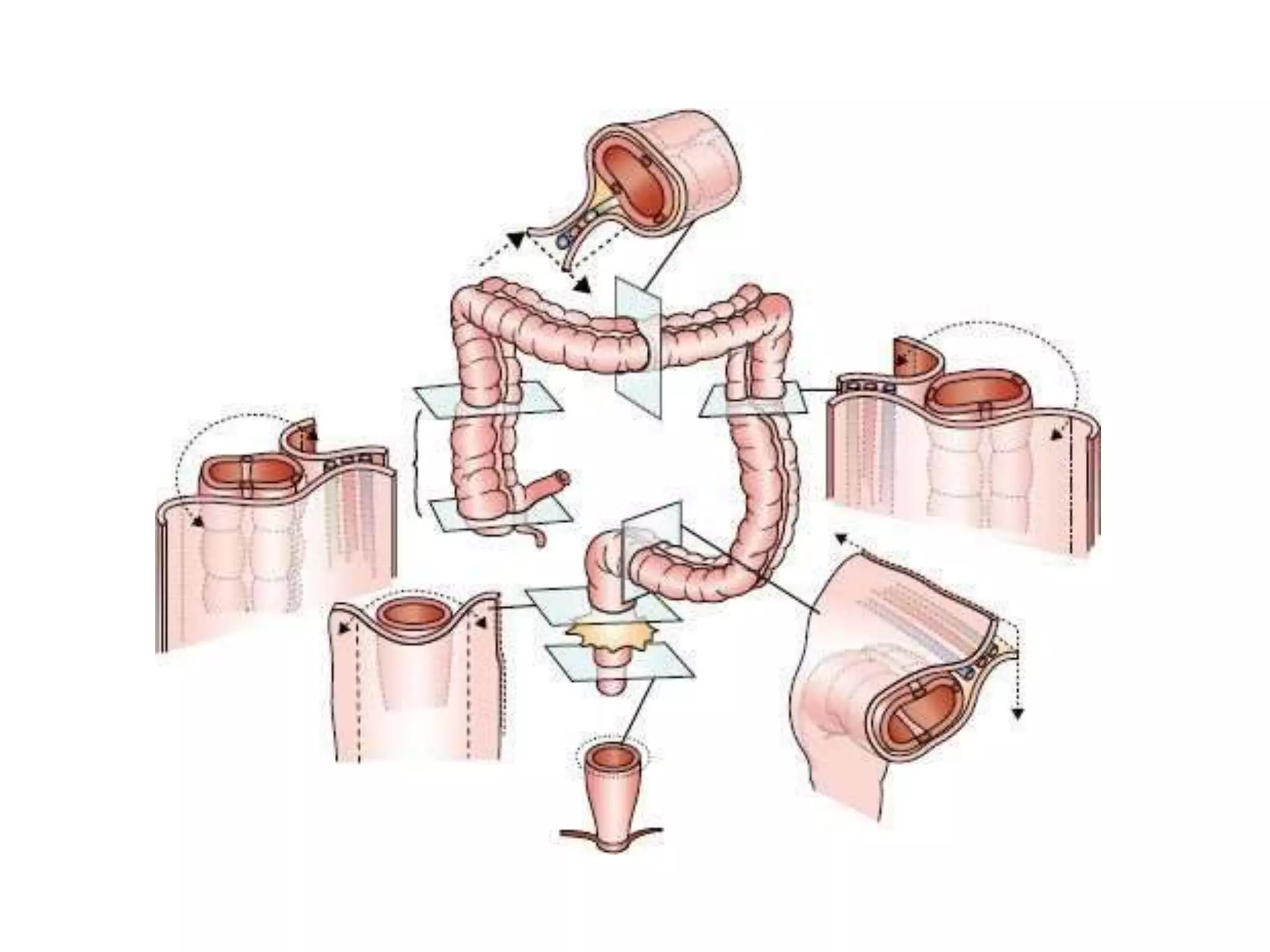 Grossing of Gastrointestinal specimens | PPTX