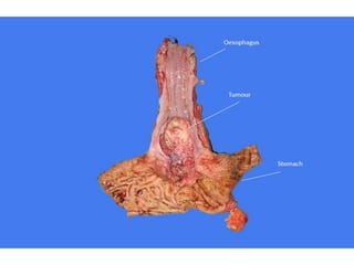 Grossing of Gastrointestinal specimens | PPTX