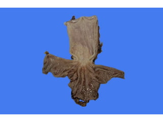 Grossing of Gastrointestinal specimens | PPTX