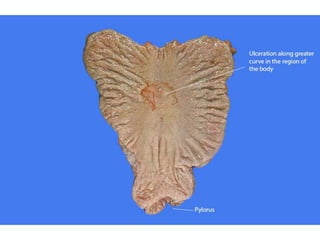 Grossing of Gastrointestinal specimens | PPTX