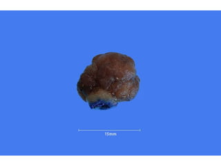 Grossing of Gastrointestinal specimens | PPTX