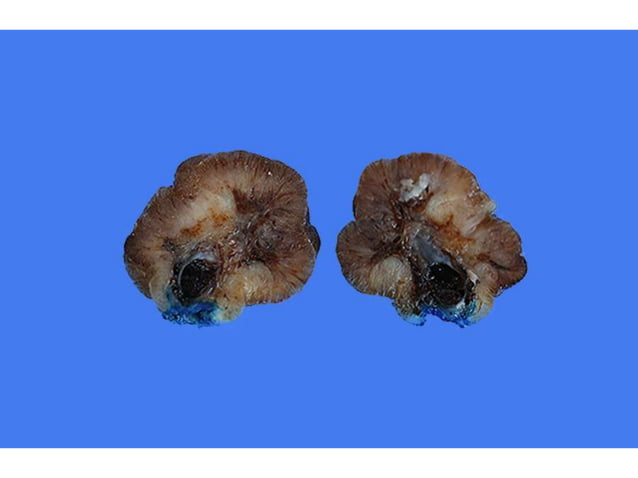 Grossing of Gastrointestinal specimens | PPTX