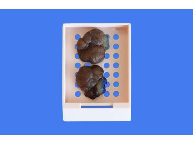 Grossing of Gastrointestinal specimens | PPTX