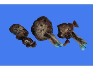 Grossing of Gastrointestinal specimens | PPTX