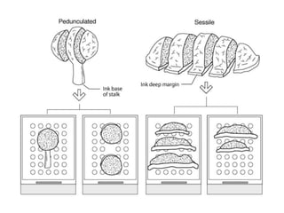 Grossing of Gastrointestinal specimens | PPTX