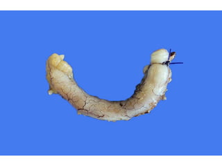 Grossing of Gastrointestinal specimens | PPTX