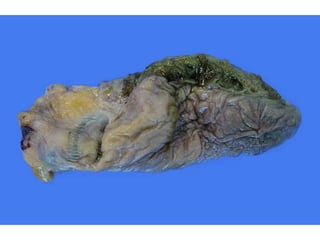 Grossing of Gastrointestinal specimens | PPTX