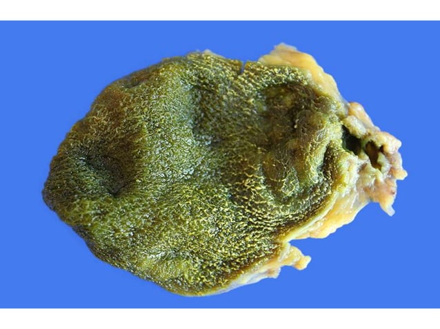 Grossing of Gastrointestinal specimens | PPTX