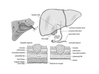 Grossing of Gastrointestinal specimens | PPTX