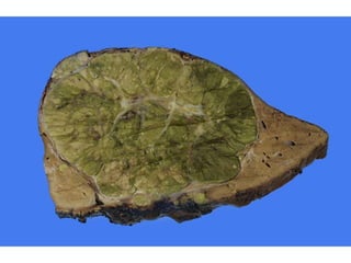 Grossing of Gastrointestinal specimens | PPTX