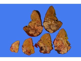 Grossing of Gastrointestinal specimens | PPTX