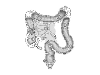 Grossing of Gastrointestinal specimens | PPTX
