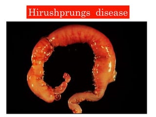 Grossing of Gastrointestinal specimens | PPTX