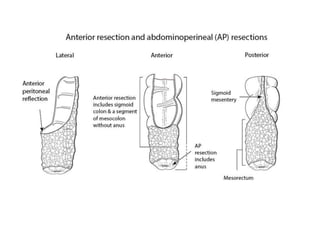 Grossing of Gastrointestinal specimens | PPTX