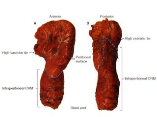 Grossing of Gastrointestinal specimens | PPTX