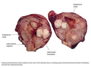 Grossing of Hysterectomies Specimen.pptx
