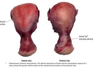 Grossing of Hysterectomies Specimen.pptx