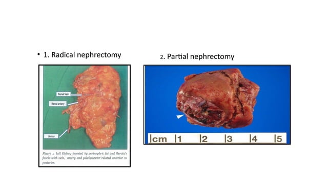 GROSSING OF KIDNEY.pptx, Anatomy and grossing | PPTX | Medical Health